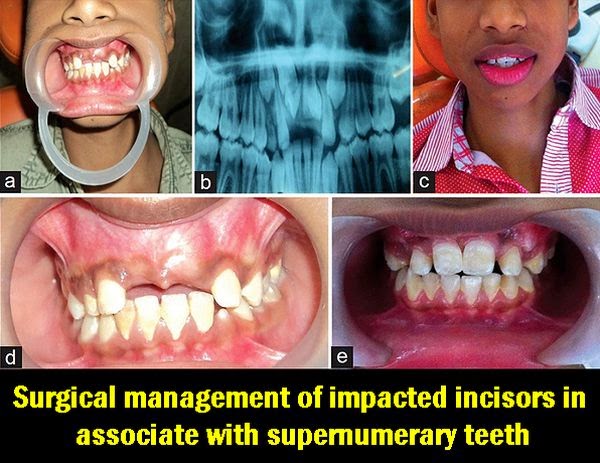 ORTHODONTICS: Surgical management of impacted incisors in associate ...