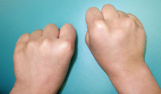 Short Fingers- Brachydactyly | Congenital Hand and Arm Differences ...