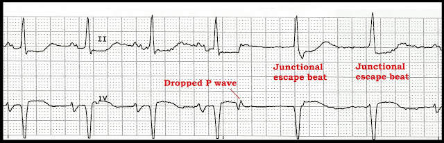 Float Nurse: Practice EKG Rhythm Strips 163