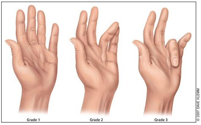 Tom's Physiotherapy Blog: Finger Injuries, Symptoms and Management