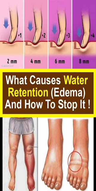 Tips on Getting Rid of Water Retention In Your Body ! | Wellness Right