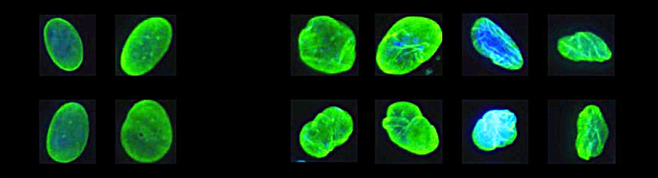 progeria family circle: cause