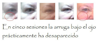 Centro de Estética Déliz: Radiofrecuencia Tripolar