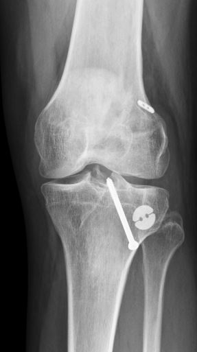 Joint Preservation and Replacement : Should'nt root lesions be a part ...