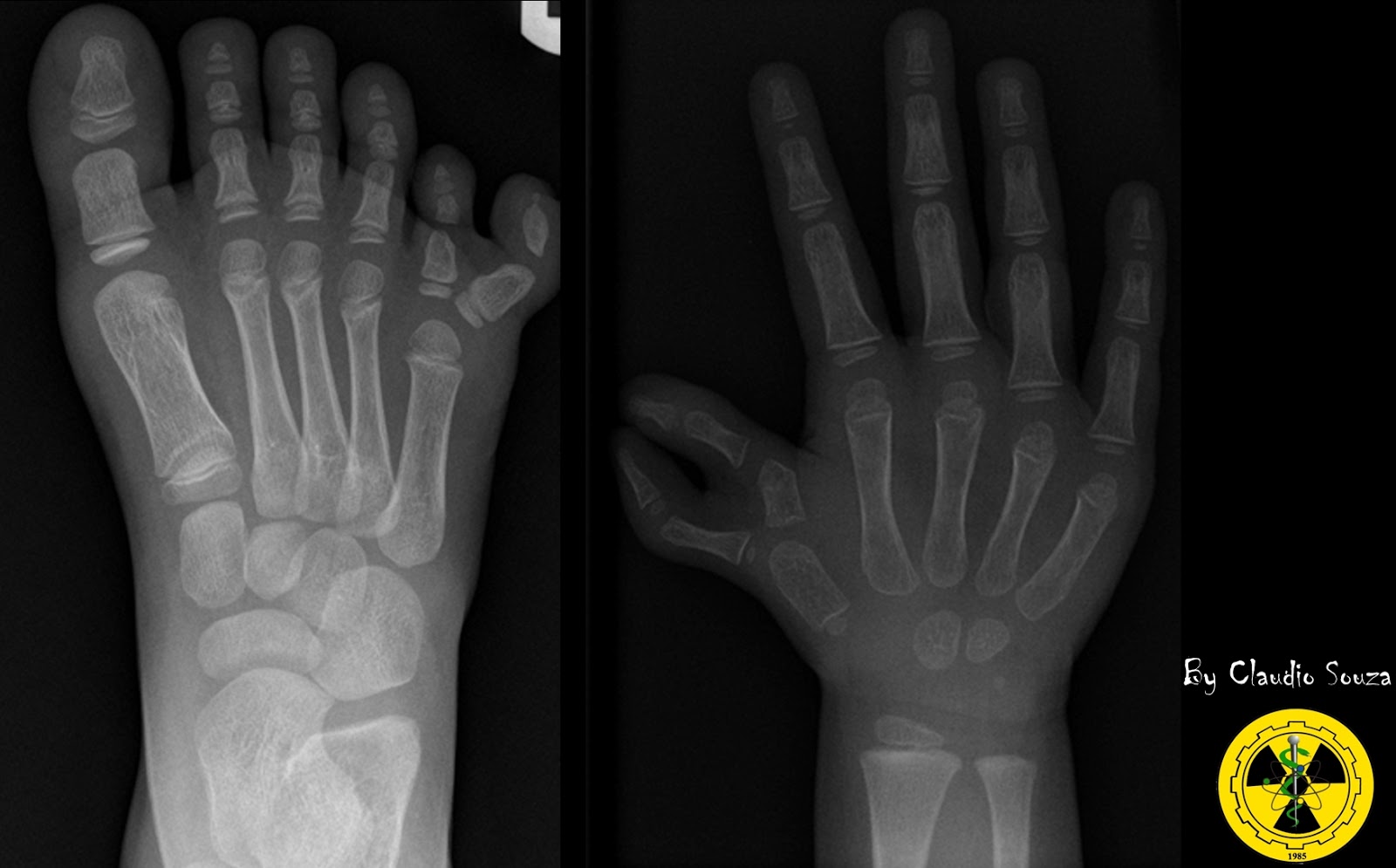 Osificaciã³N Heterotã³Pica; OsificaciÃ³n PatolÃ³gica
