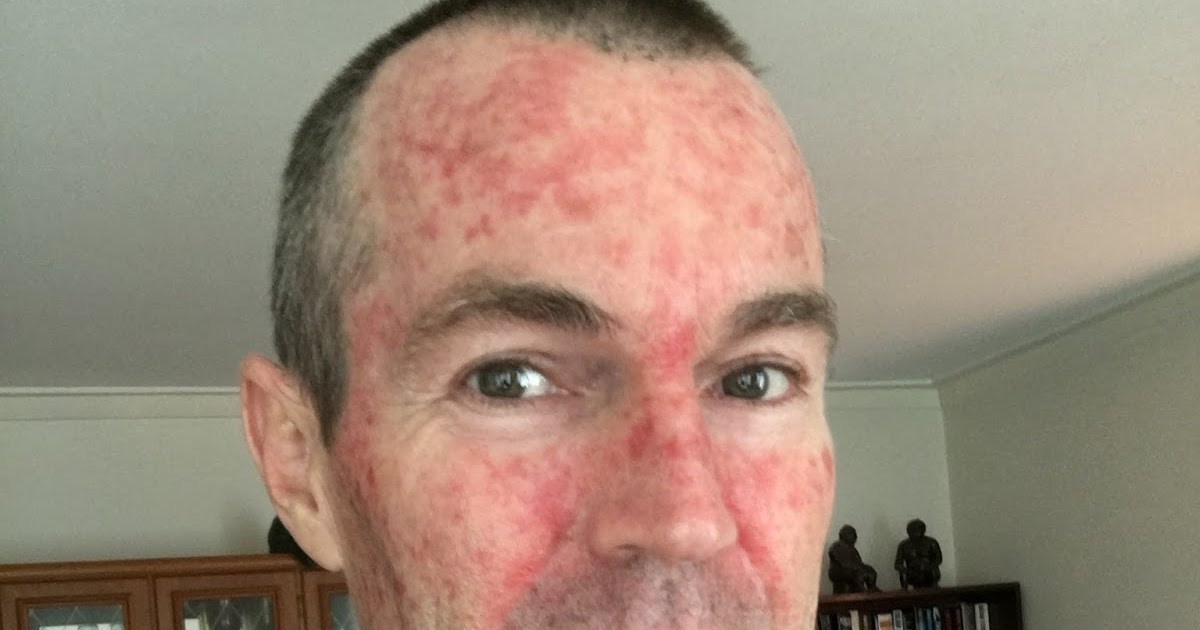 Efudix Treatment: Day 11 - Life Goes On