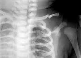 Doctor Adesanya's blog: How to manage fractured clavicle in a newborn