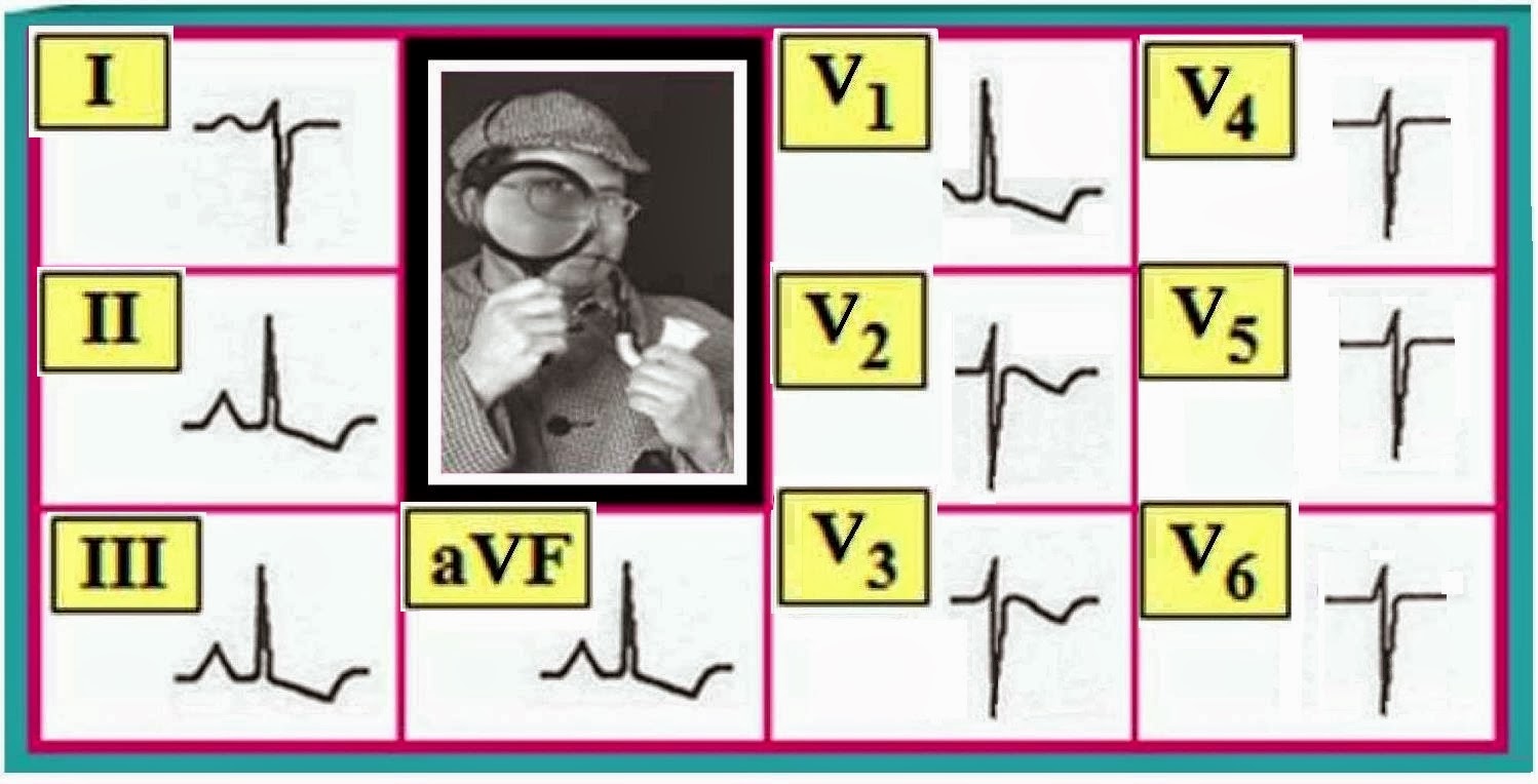 ECG Interpretation: ECG Interpretation Review #77 (Chamber Enlargement ...