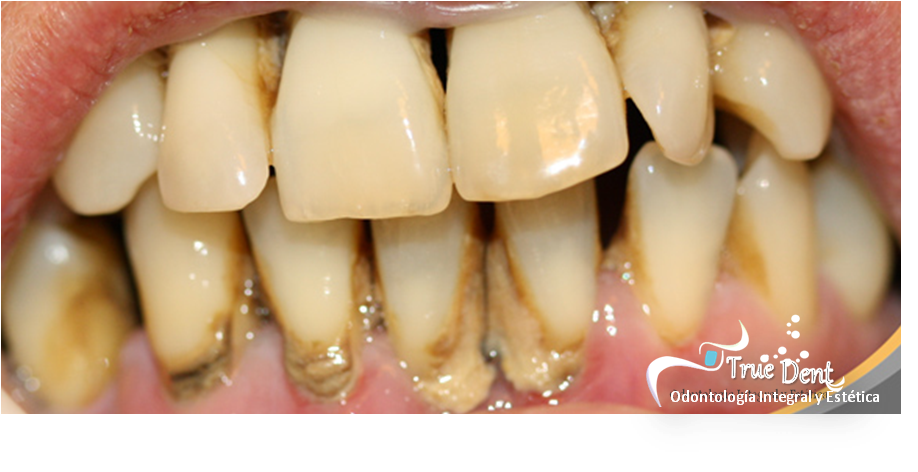 TRUEDENT: EL SARRO: ENEMIGO DE NUESTRA SALUD BUCAL Y ESTETICA DE ...