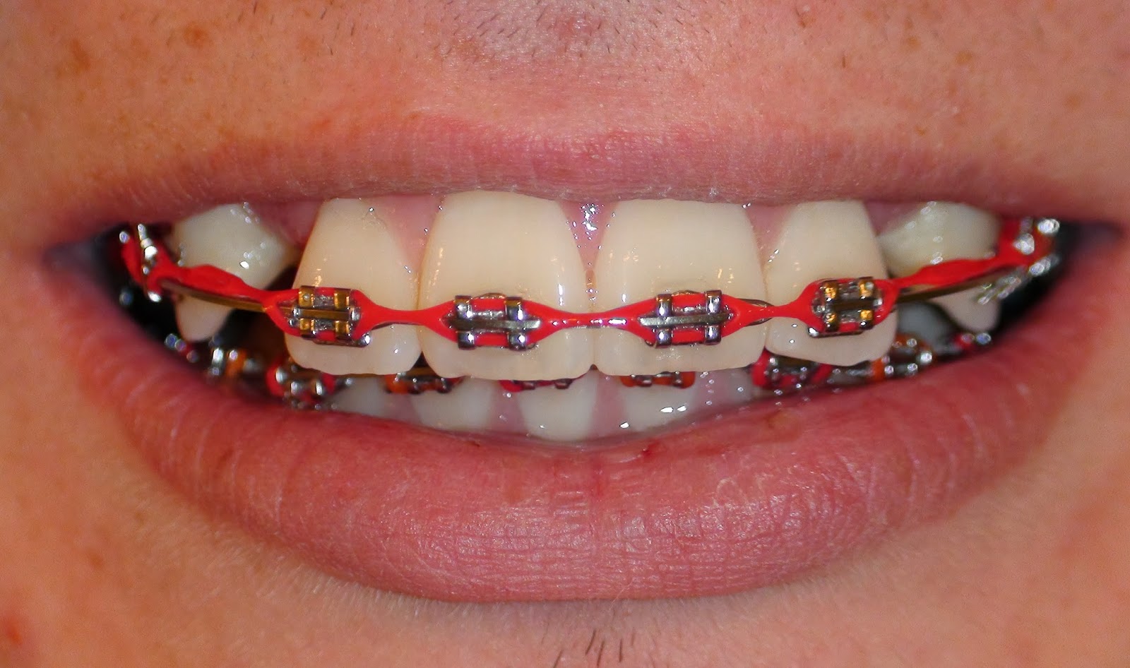 Red Colored Braces