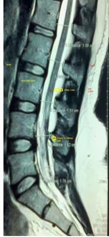 Neurosurgeon India: Limited Dorsal Spinal Rachischisis