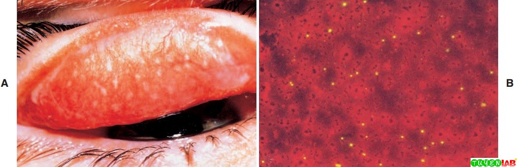 [Microbiology] Atlas of Ocular Infections | Free Medical Atlas