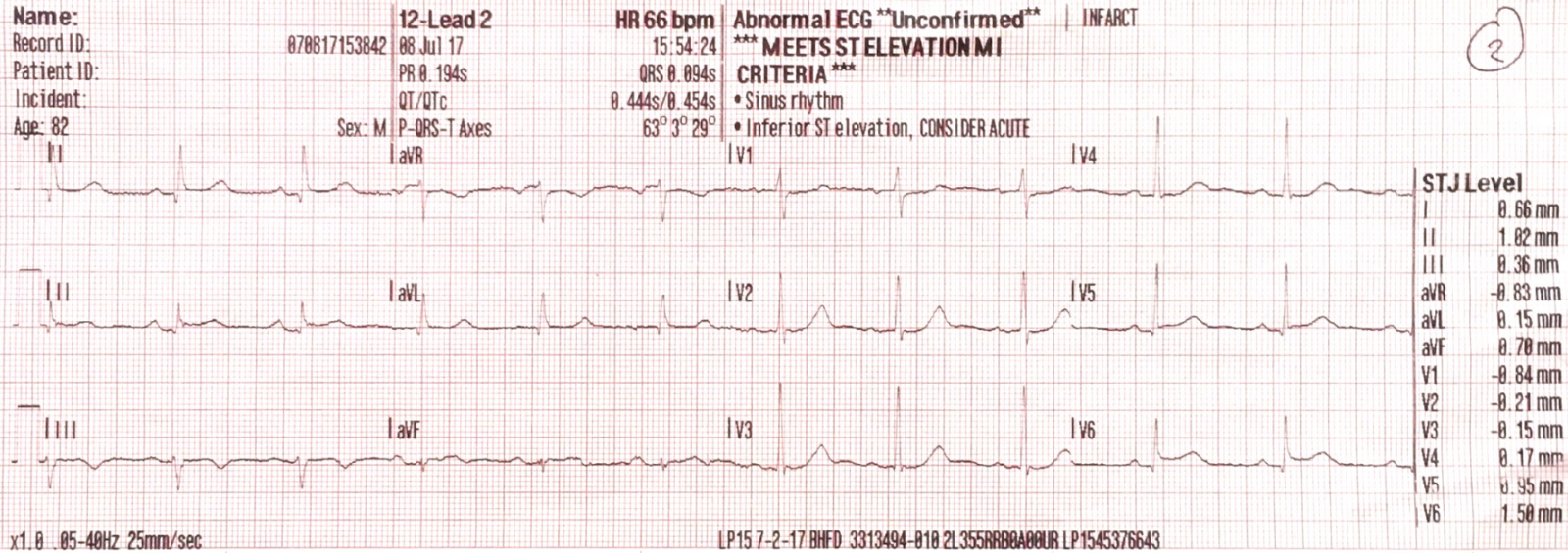 Блог по клинической электрофизиологии: декабря 2017