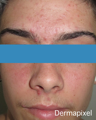 Dermapixel: mayo 2020