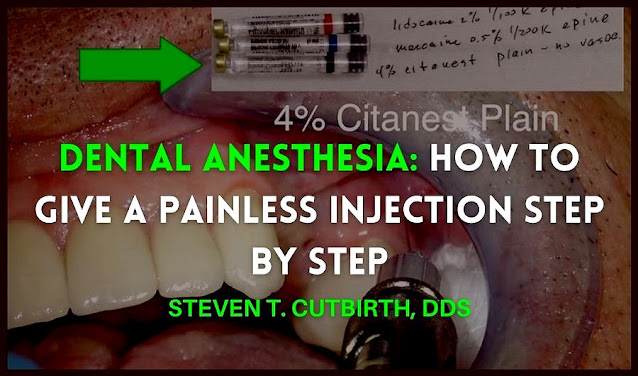 DENTAL ANESTHESIA: How to Give a Painless Injection Step by Step ...