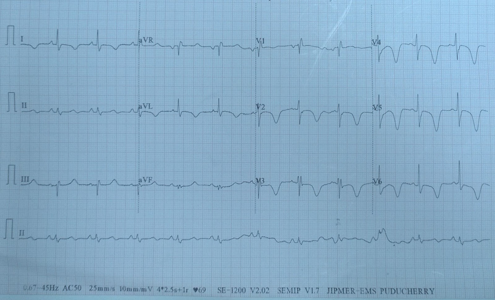 Cardiology window: Monomorphic Ventricular tachycardia ? What is your ...
