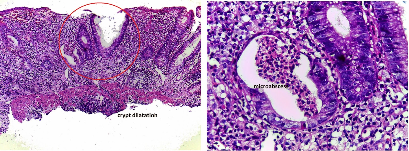 GASTROINTESTINAL AND LIVER HISTOLOGY PATHOLOGY ATLAS: COLON: ULCERATIVE ...