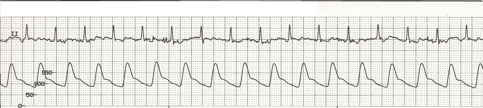 Various rhythms with arterial blood pressure waveform