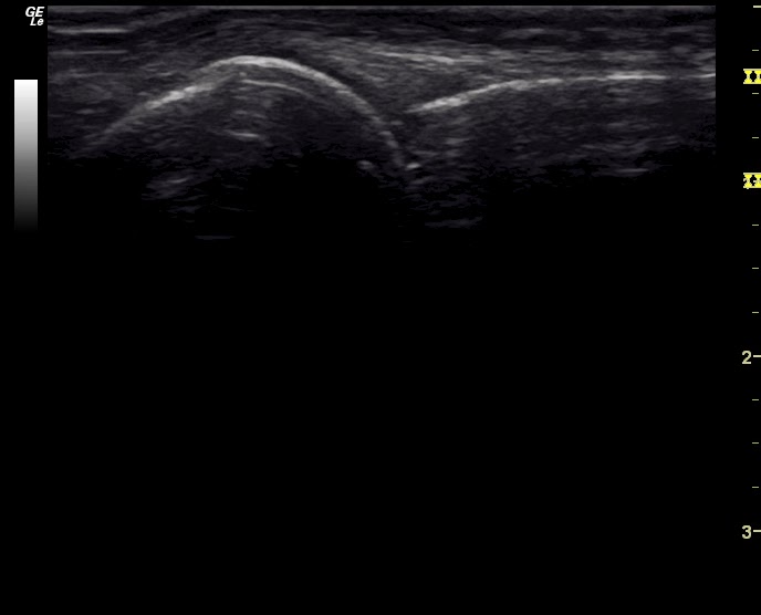 Reumails. Reumatología al día: Urticaria y tumefacción articular ...