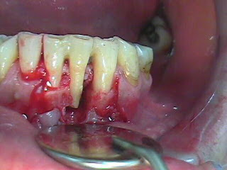 Dental sky - All about healthy smile: Do you need an apicoectomy?