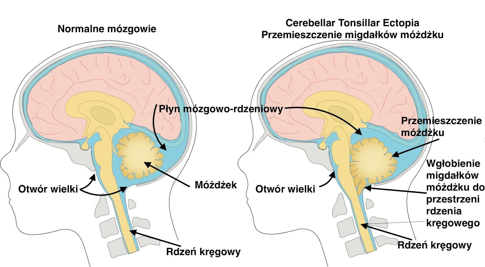 EDS i bóle głowy - czym jest Zespół Chiari, nadciśnienie śródczaszkowe ...