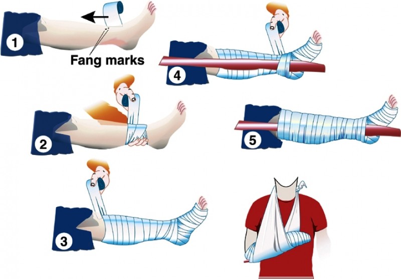 Pengertian, Gejala, Cara Benar Pertolongan Pertama, dan Penanganan ...