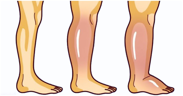 Pour combattre la rétention d'eau et l'enflure dans les jambes, essayer ...