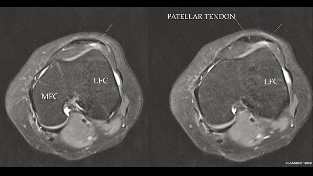 Ultimate Radiology : Hoffa's Fat Pad Impingement Syndrome