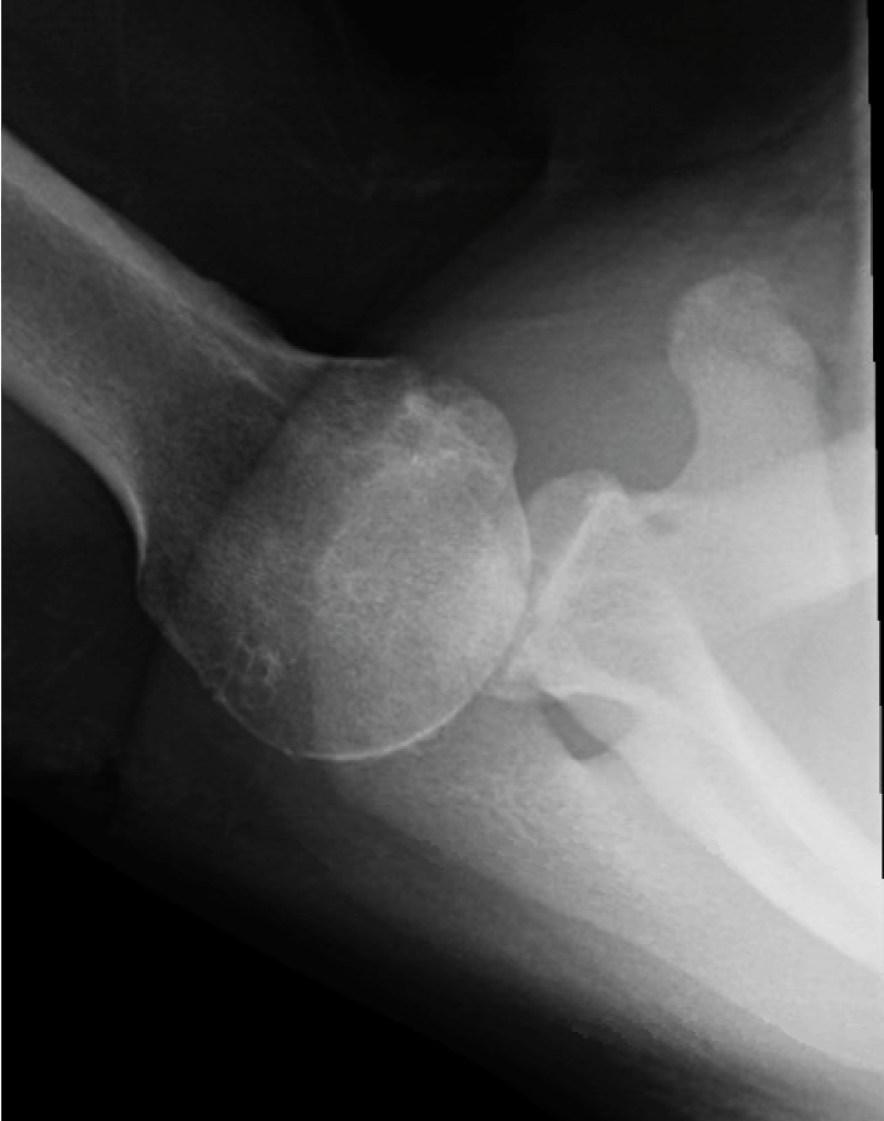 Shoulder Arthritis / Joint Replacement : The arthritic shoulder ...