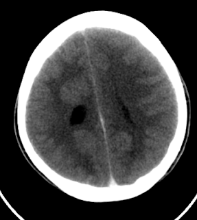 Grey matter heterotopia-MRI - Sumer's Radiology Blog