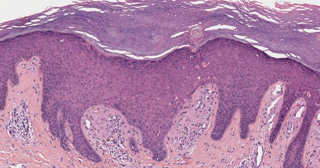 Differential Diagnosis in Dermatopathology: Pink staining