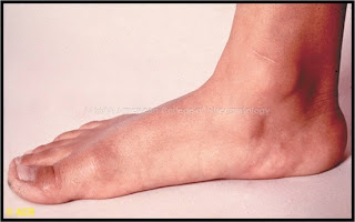Medische Kennis: Klachten van de enkel en de voet