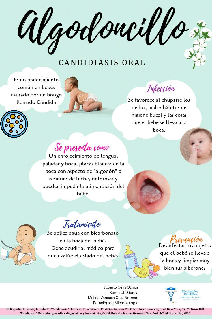 DIVULGACIÓN CIENTÍFICA UG: Oral Candidiasis in children.
