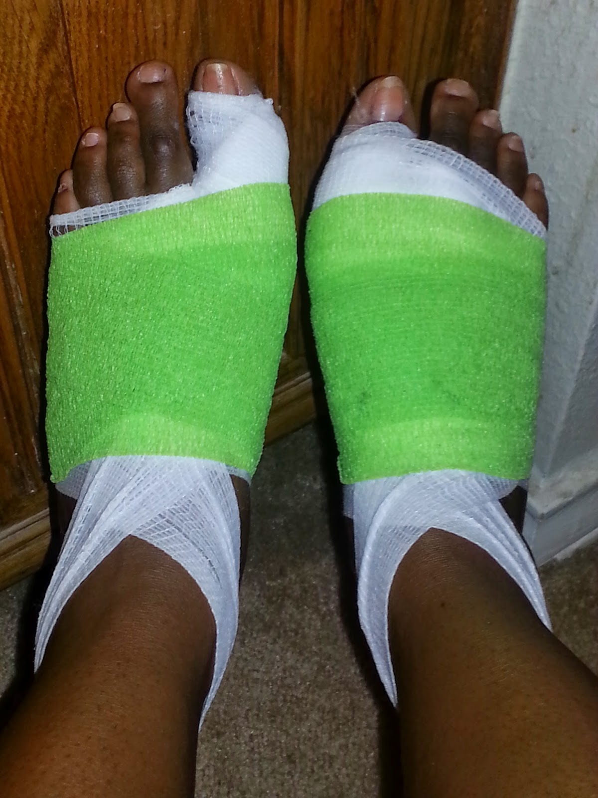 Scarf Akin Procedure