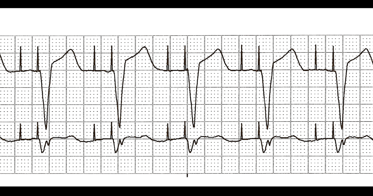 Float Nurse: Practice EKG Strips 310