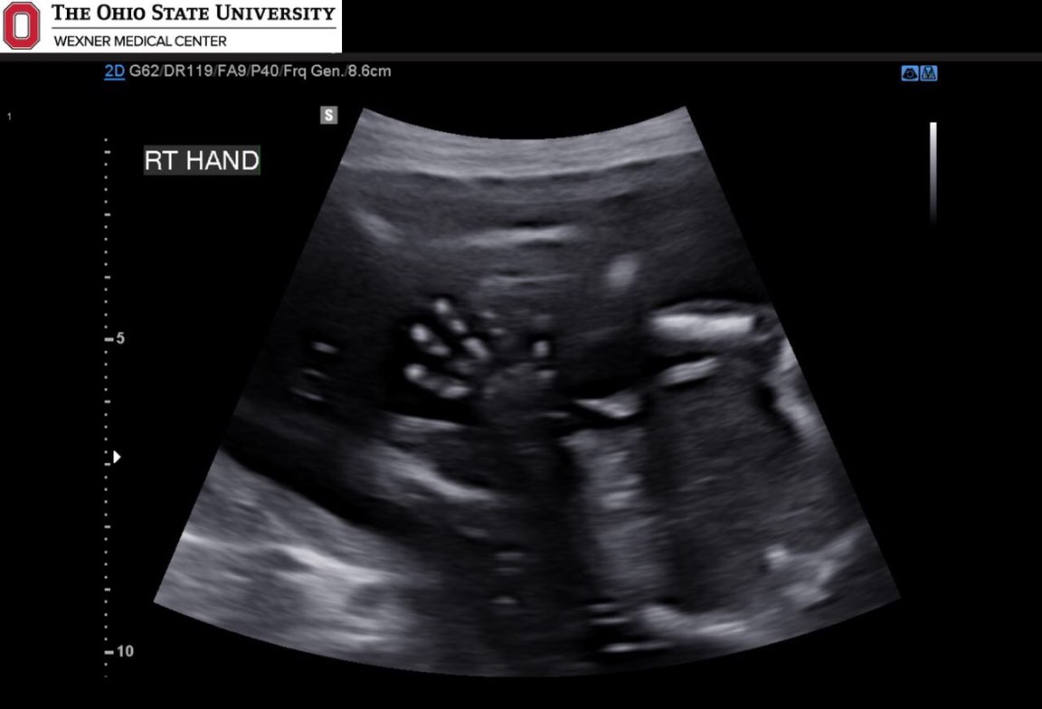 BARNETT BABY: 18 WEEK ULTRASOUND!!!