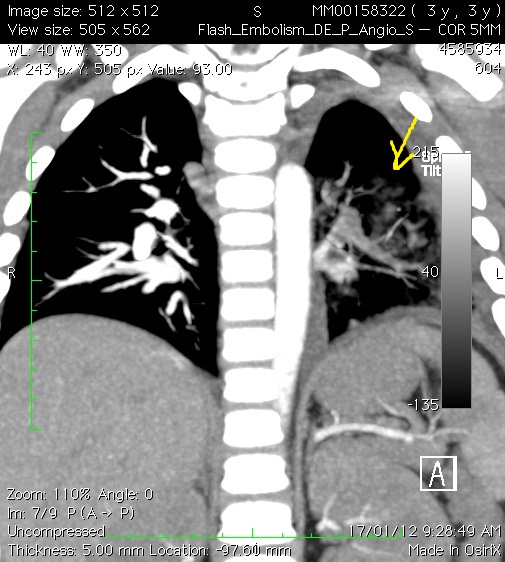 Pulmonary Embolism-CTPA - Sumer's Radiology Blog