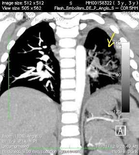 Pulmonary Embolism-CTPA - Sumer's Radiology Blog