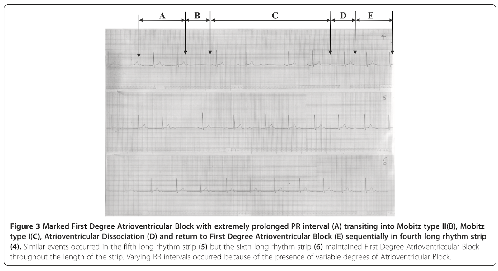 Hospitalist ~なんでも無い科医の勉強ノート~: 著明な1度房室ブロック "Marked first degree AVB"