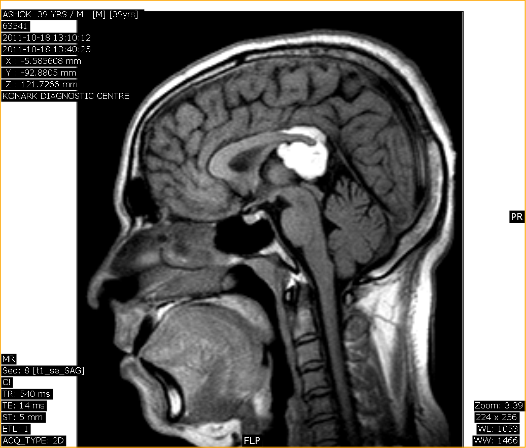 drvcsradiodiagnosis: corpus callosal lipoma- case report