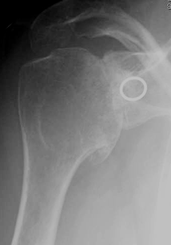 Shoulder Arthritis / Rotator Cuff Tears / Shoulder Pain : Total ...