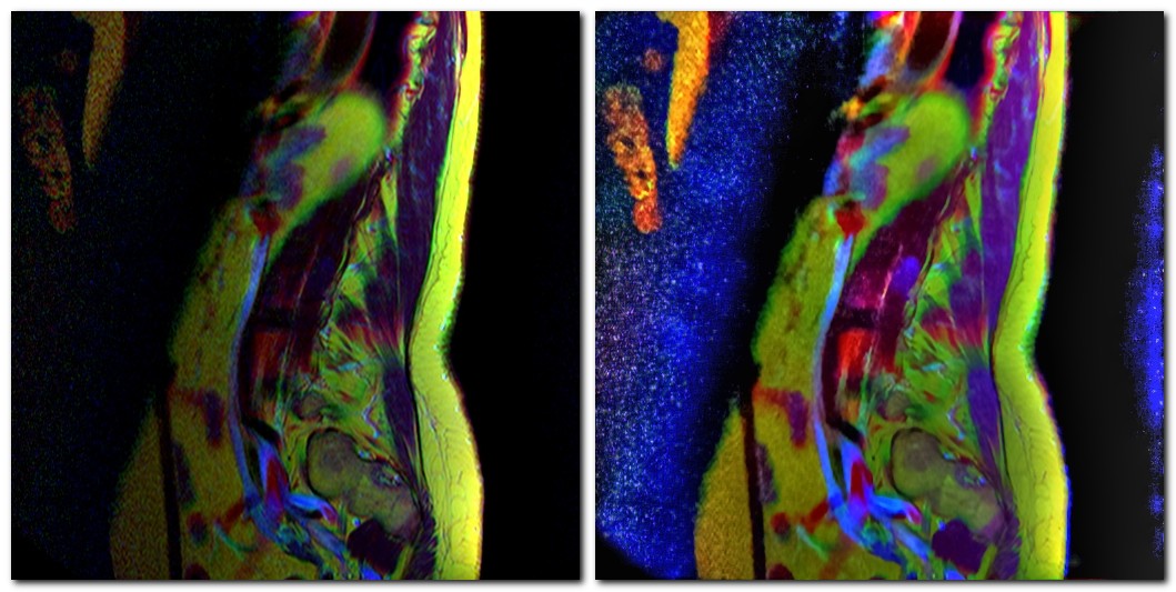 Nevit's blog: Color MRI of the Lumbar spine tonemapped.
