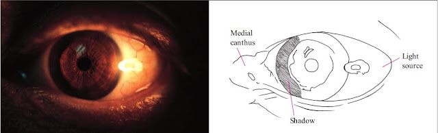 [Emergency] ATLAS OF ACUTE ANGLE-CLOSURE GLAUCOMA | Free Medical Atlas