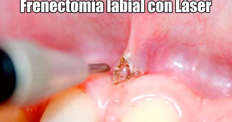 FRENECTOMÍA LABIAL: Cirugía con Láser - Odonto-Tv
