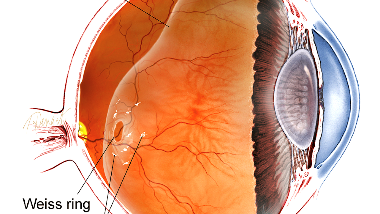 Eye Floater Laser Treatment Treat Choices Eye Floater Laser Treatment Treat Choices