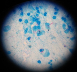 Pengecatan Bakteri Tahan Asam (BTA) ~ Analis Kesehatan Indonesia