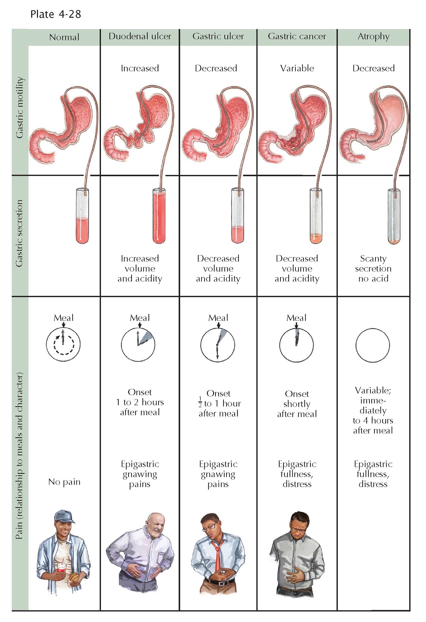 FUNCTIONAL CHANGES IN GASTRIC MOTILITY AND SECRETION IN GASTRIC ...