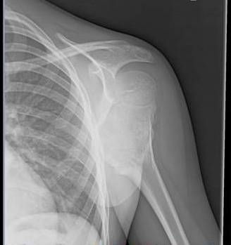 Exostosis-not always easy to identify! - Sumer's Radiology Blog