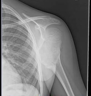Exostosis-not always easy to identify! - Sumer's Radiology Blog