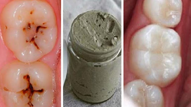 CT SALUD NATURAL: Elimina las caries, cura las encías y blanquea tus ... CT SALUD NATURAL: Elimina las caries, cura las encías y blanquea tus ...
